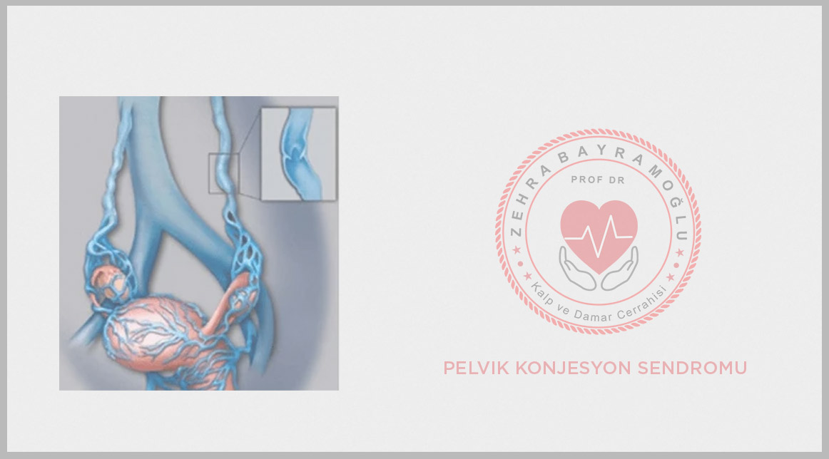 Pelvik Konjesyon Sendromu - Pelvik Konjesyon Hastalığı